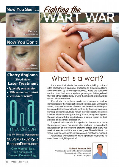 Tangi Lifestyles - Fighting the Wart War | Benson Dermatology